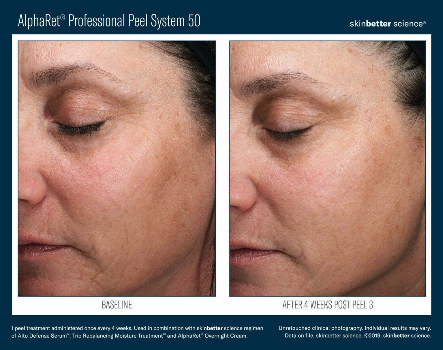 Chemical Peels Atlanta - Swan Center for Plastic Surgery